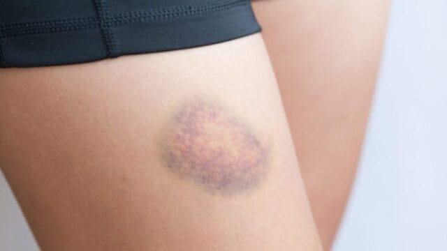 Diferencia entre equimosis y hematoma