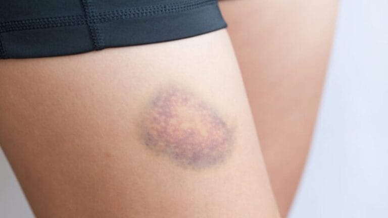 Diferencia entre equimosis y petequiae