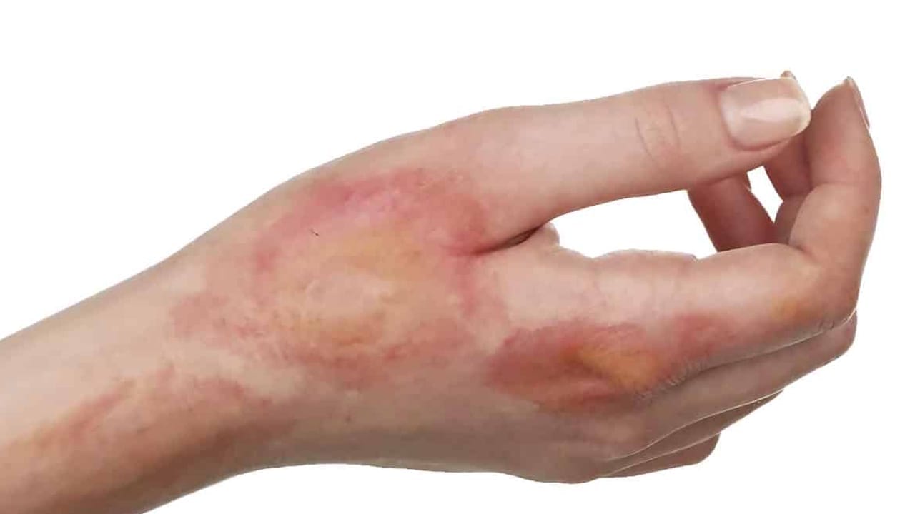 Diferencia entre quemaduras de primer, segundo y tercer grado